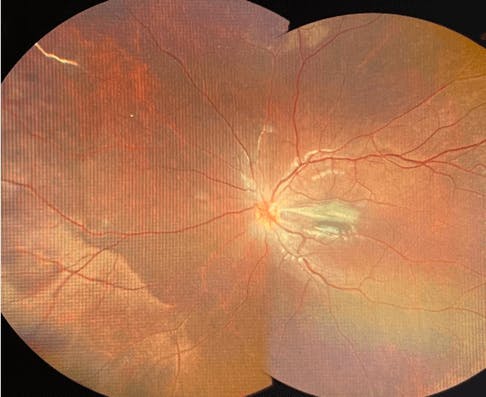 Collaborative Case #006: Red Tied - Modern Optometry