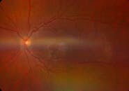 Collaborative Case #007: Cracked Egg - Modern Optometry