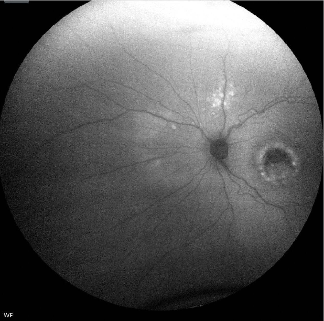 Collaborative Case #007: Cracked Egg - Modern Optometry