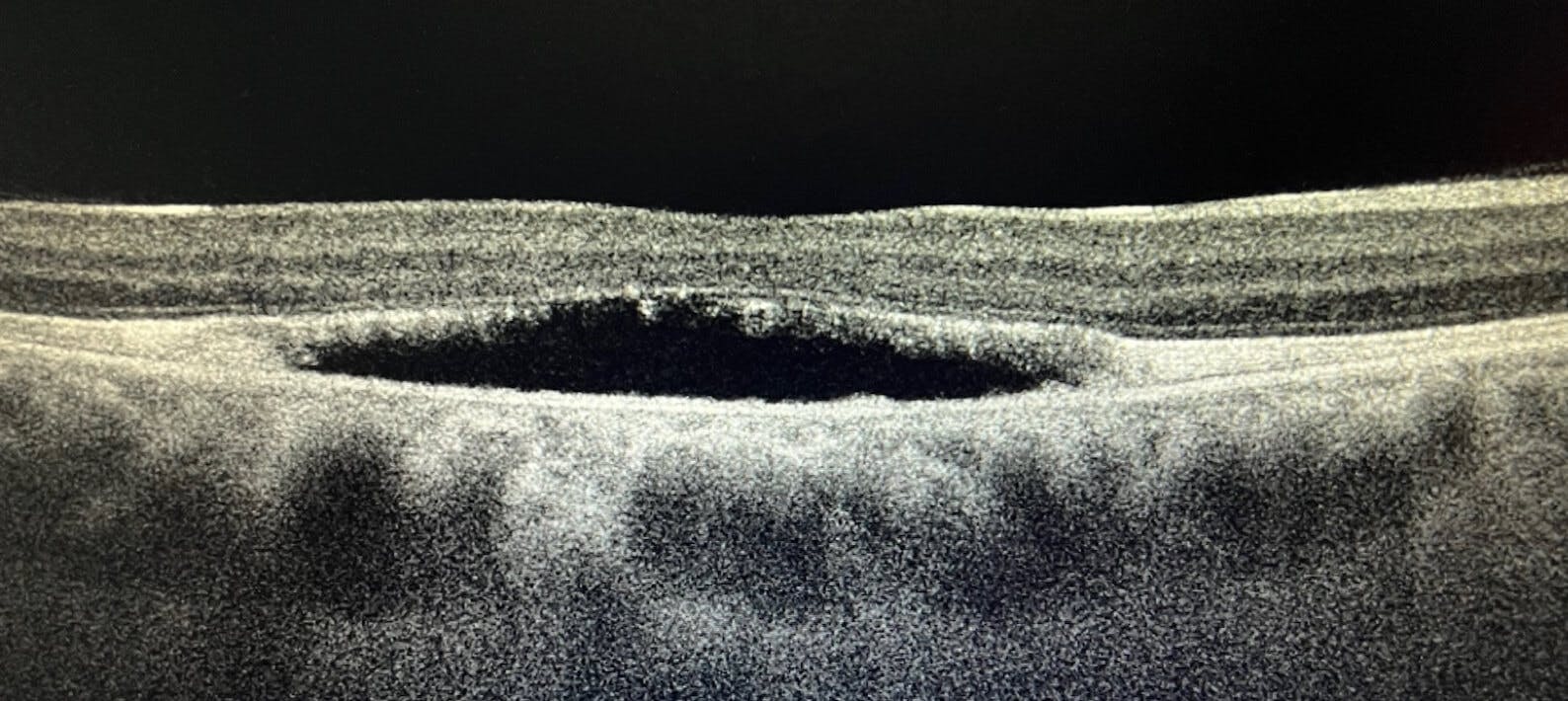 Collaborative Case #007: Cracked Egg - Modern Optometry