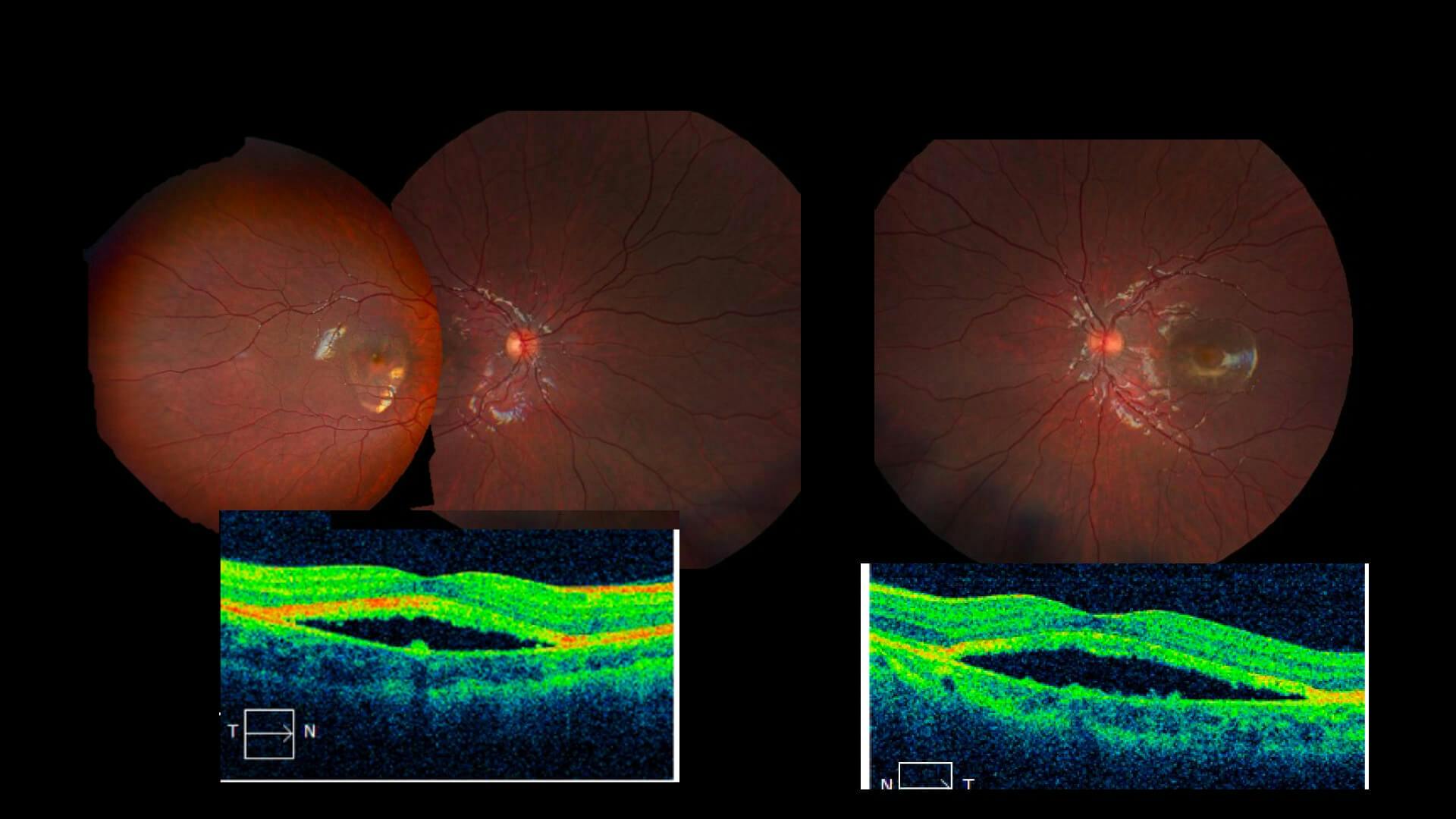 Collaborative Case #007: Cracked Egg - Modern Optometry