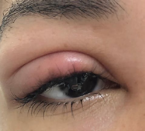 Orbital Disorders - Modern Optometry