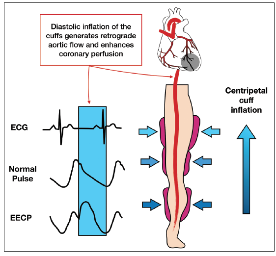Novel Nonpharmacologic Therapies for Patients With Refractory Angina ...