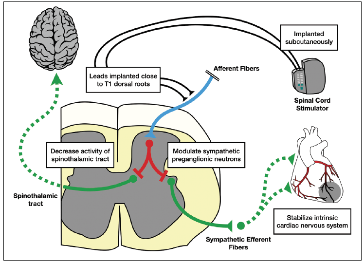 Novel Nonpharmacologic Therapies for Patients With Refractory Angina ...