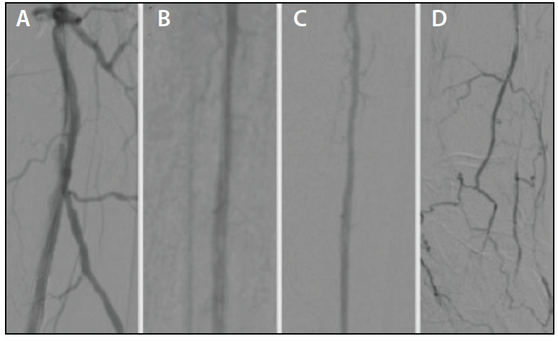 Medtronic Medical Affairs Corner: A Year in Review - Endovascular Today