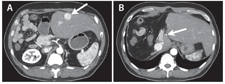 Chemoembolization Via Intrahepatic Collateral Arteries - Endovascular Today