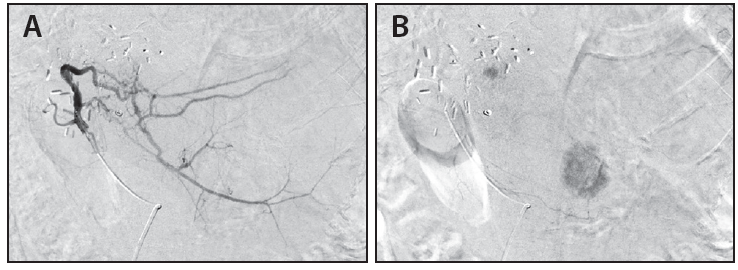 Chemoembolization Via Intrahepatic Collateral Arteries - Endovascular Today