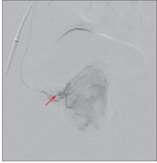 Prostate Artery Embolization* - Endovascular Today