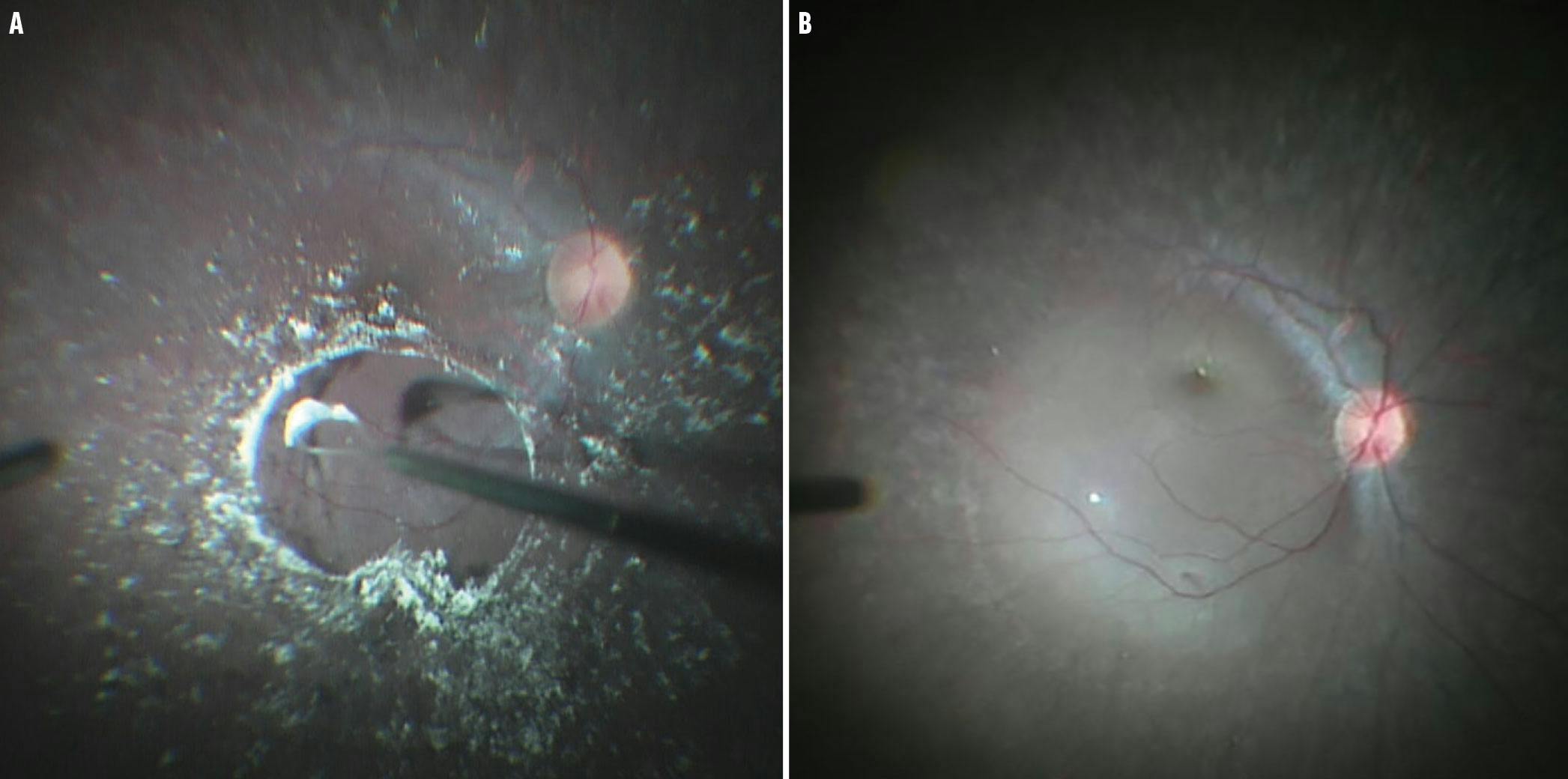 Drug Delivery Beyond the Intravitreal Space - Retina Today