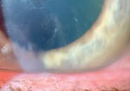 Cornea/Anterior Segment - Modern Optometry