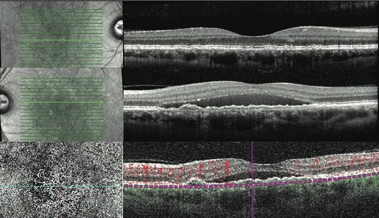 Identifying AMD Overlap Syndromes - Retina Today