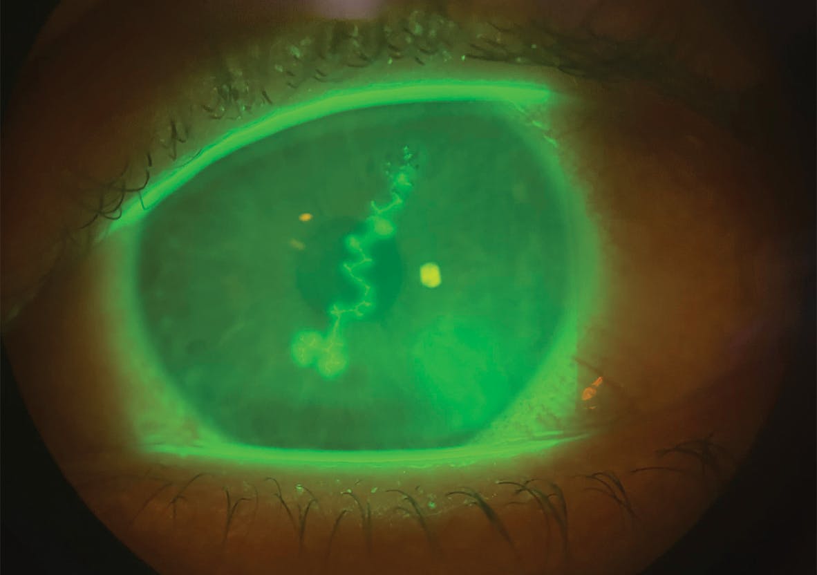 Hsv Dendritic Keratitis Rose Bengal