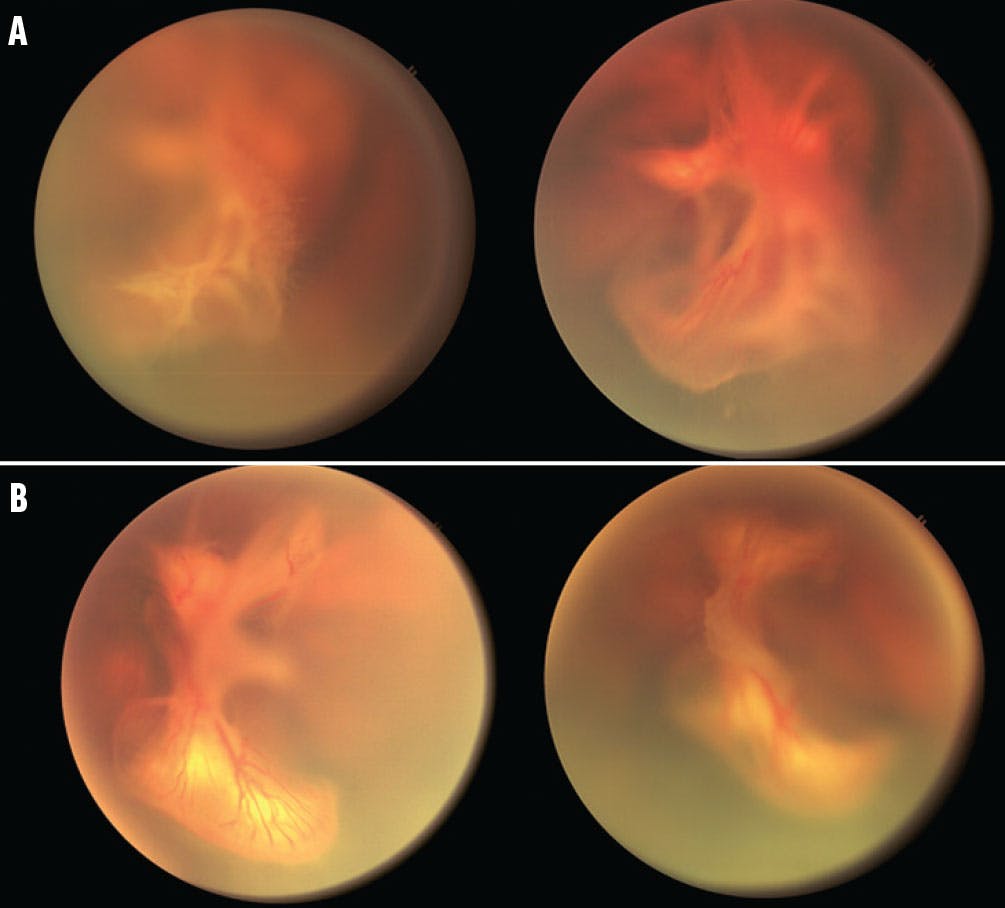 Pediatric Retina Cases and Conclusions - Retina Today