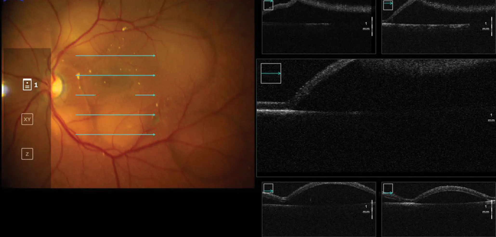 Novel Surgical Techniques to Master - Retina Today