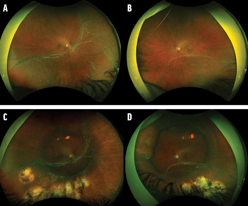 An Old Technique Made New: Scleral Buckling - Retina Today