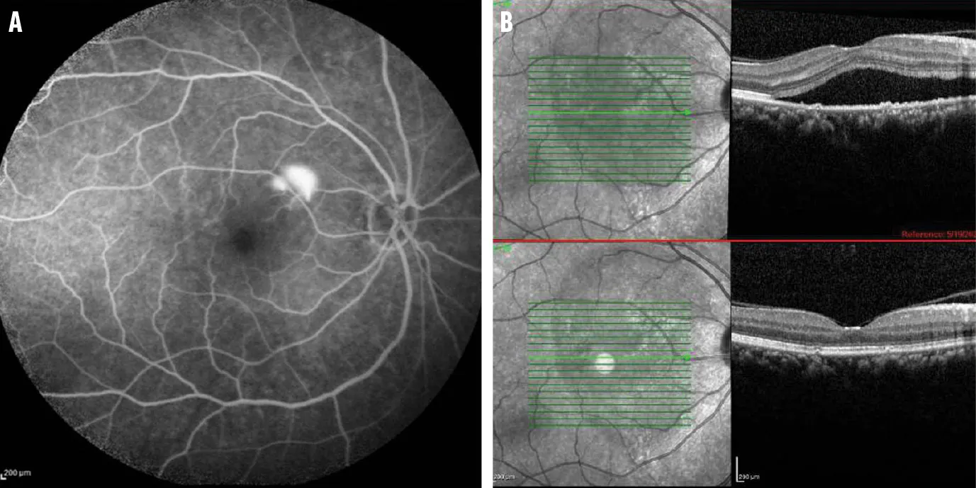 Subthreshold Laser Therapy for CSCR - Retina Today