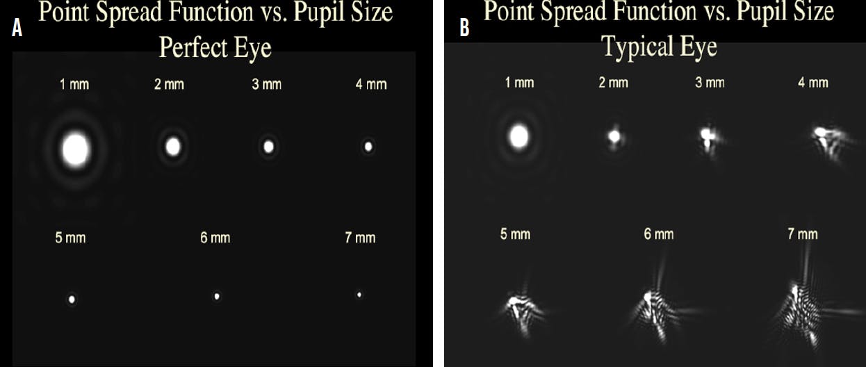 What Is the Optimal Pupil Size? - YoungMD Connect