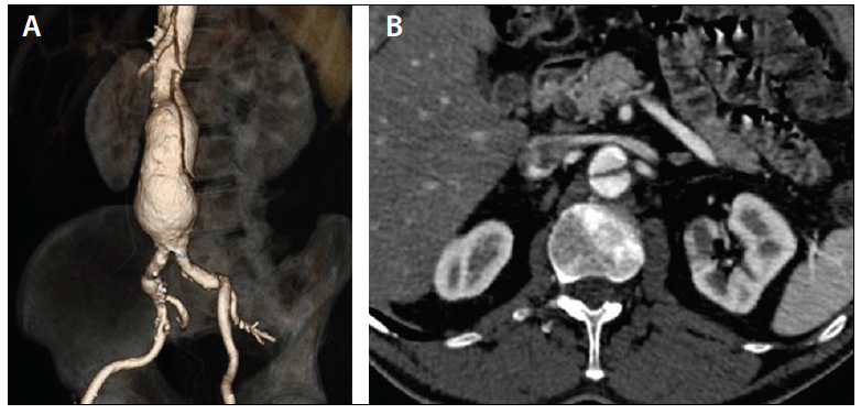 Treating Residual Dissection: When and How to Prepare an Infrarenal ...