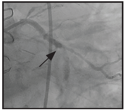 Innovation in Coronary Mechanical Thrombectomy: Indigo® System CAT™ RX ...