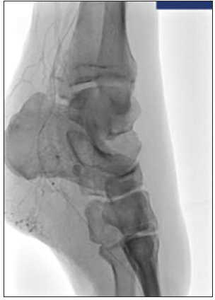 Innovation in Coronary Mechanical Thrombectomy: Indigo® System CAT™ RX ...