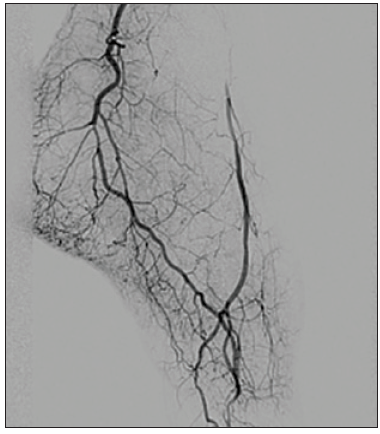 Innovation in Coronary Mechanical Thrombectomy: Indigo® System CAT™ RX ...