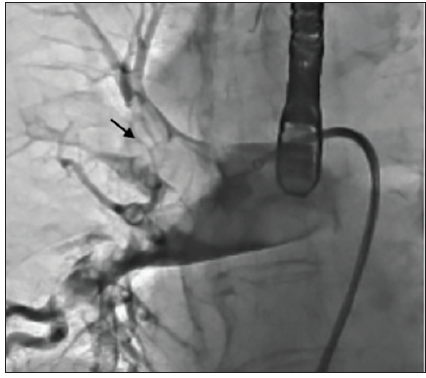 Innovation in Coronary Mechanical Thrombectomy: Indigo® System CAT™ RX ...
