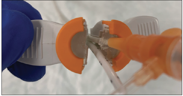 Single-Access Technique for Impella-Assisted High-Risk PCI - Cardiac ...