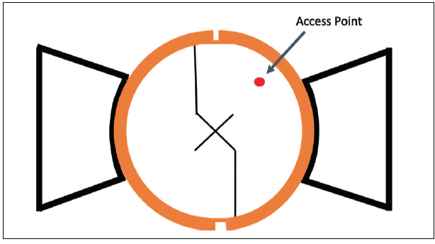 Single-Access Technique for Impella-Assisted High-Risk PCI - Cardiac ...