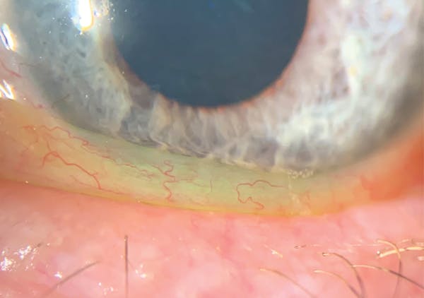 Ocular Surface - Modern Optometry