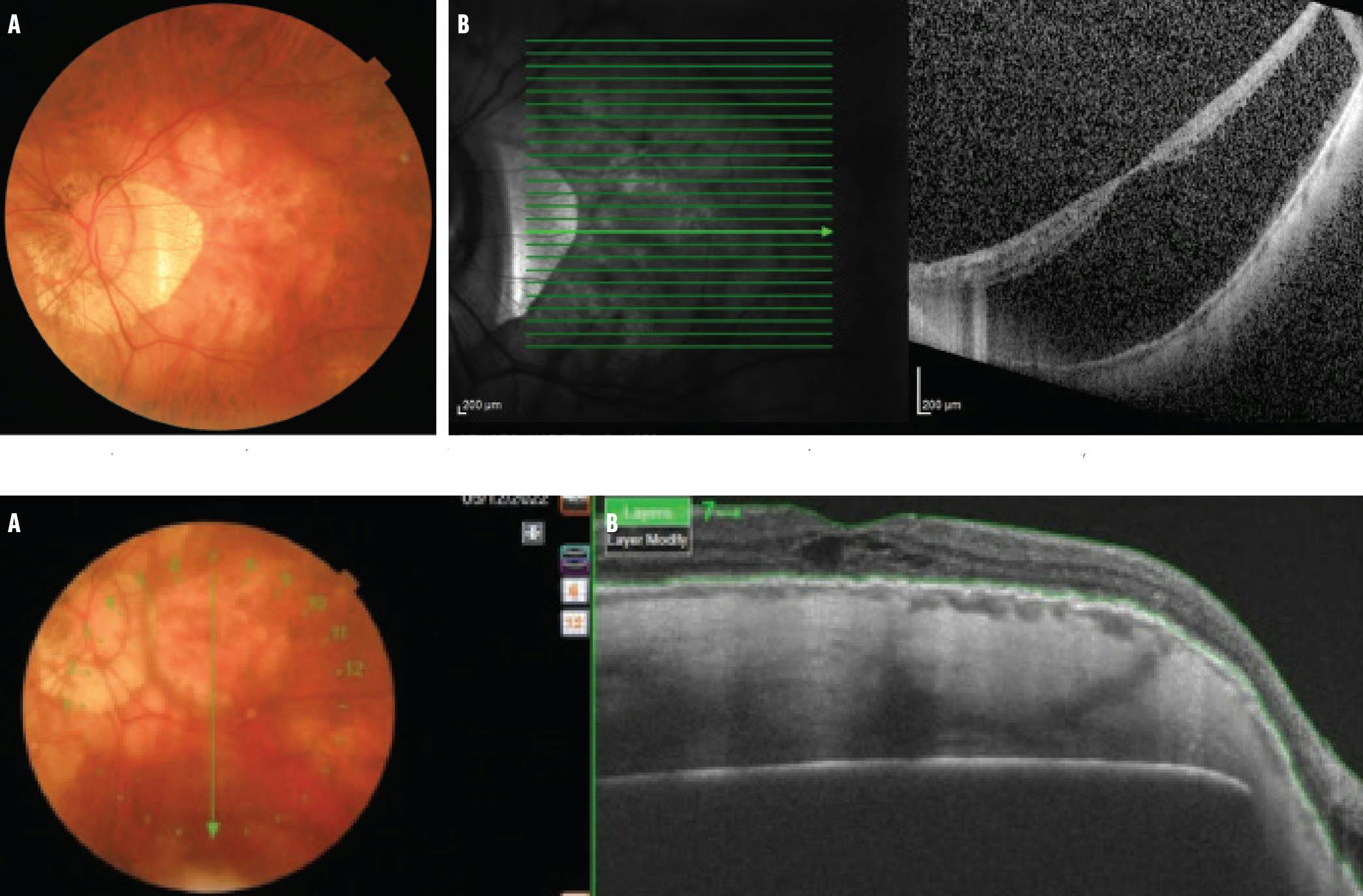 Macular Buckling for Myopia: A Novel Approach - Retina Today