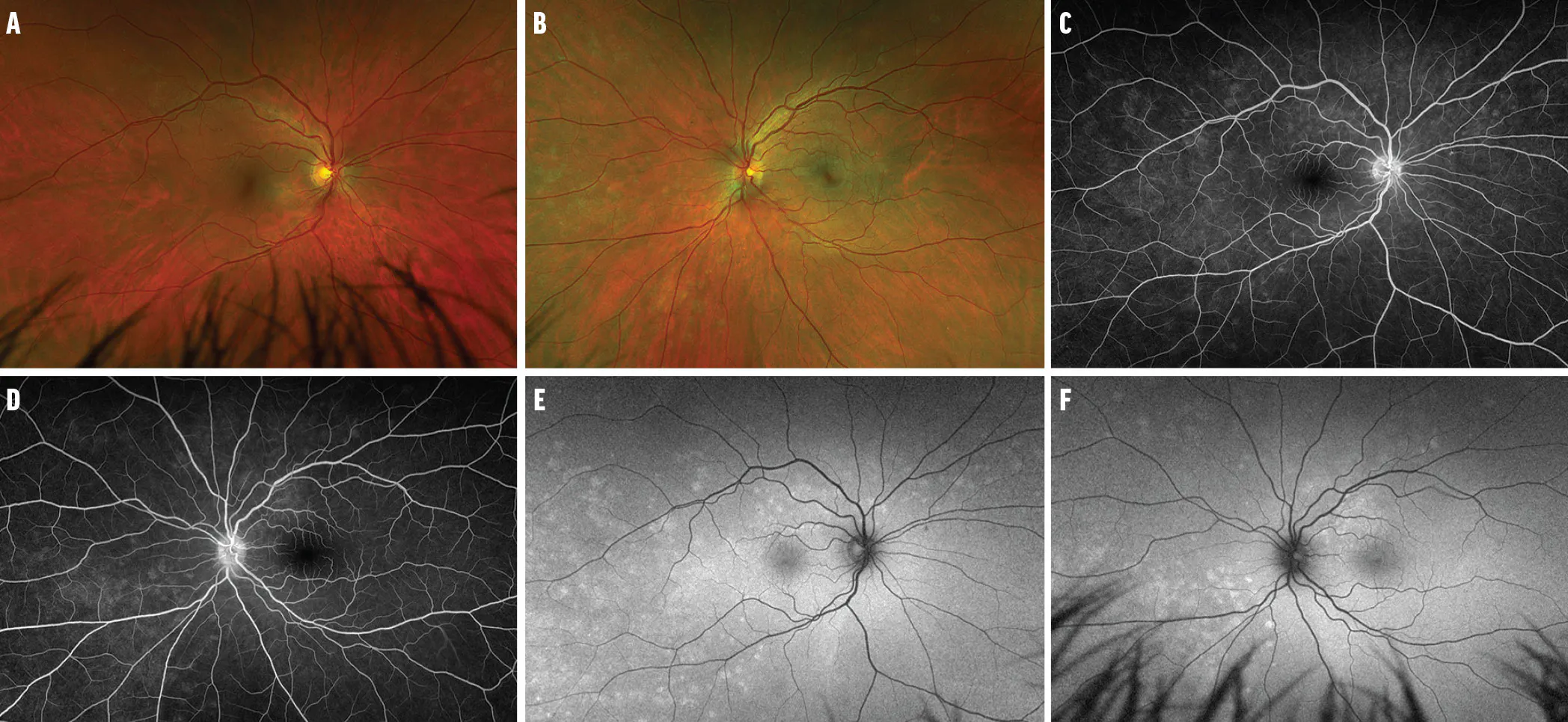 When Sex Becomes Relevant in the Retina Clinic - Retina Today