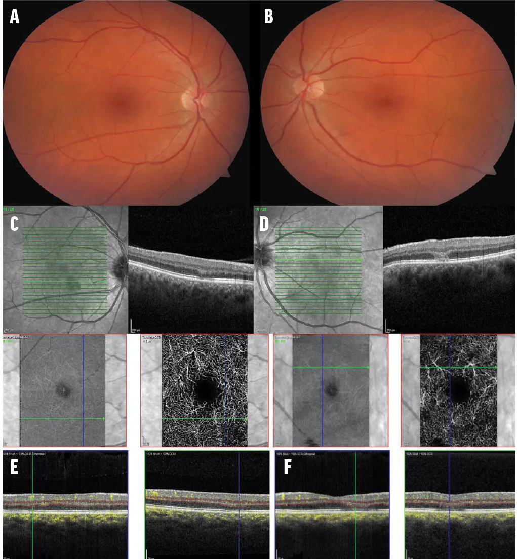 Acute Retinopathy Following Weightlifting Supplement - Retina Today