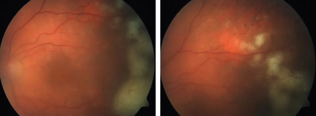 Neoplastic Masqueraders of Uveitis - Retina Today