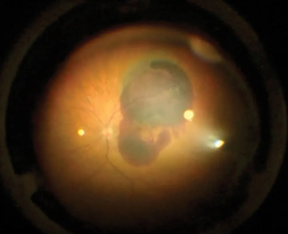 Submacular Hemorrhage Managed With Subretinal tPA - Retina Today