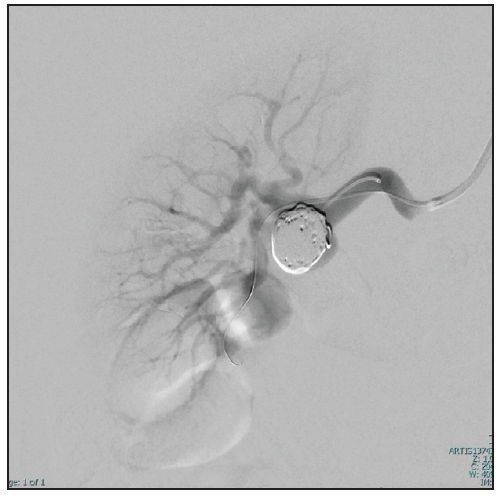Durable and Efficient Embolisation With Ruby, POD, and Packing Coil ...