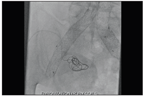 Durable and Efficient Embolisation With Ruby, POD, and Packing Coil ...