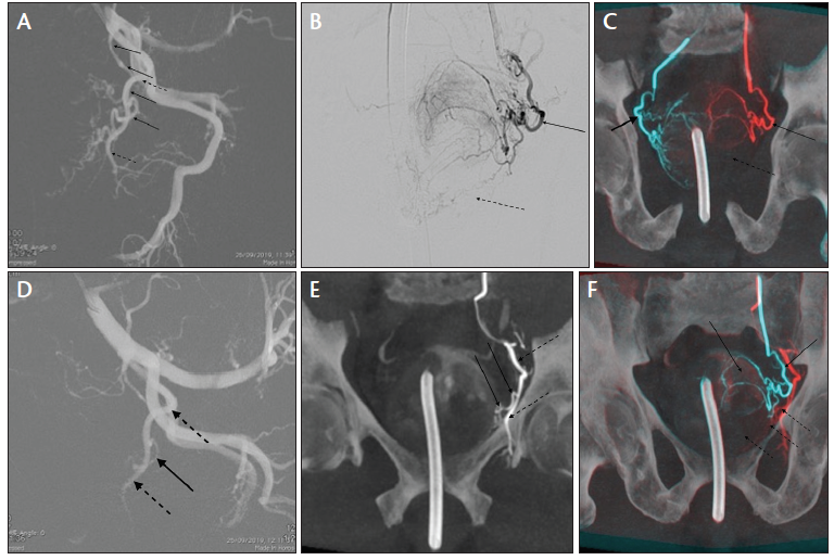 Prostatic Artery Embolization For Benign Prostatic Hyperplasia A 10 Year Update Endovascular