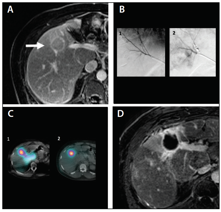 Embolic Locoregional Therapy for the Treatment of Hepatocellular ...