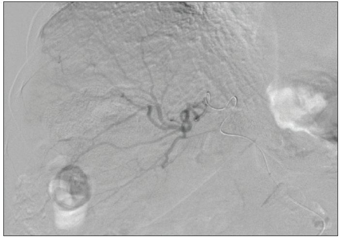 Selective Liver Embolization in Unresectable, Multifocal Hepatocellular ...