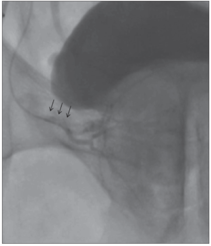 Prostate Artery Embolization* - Endovascular Today