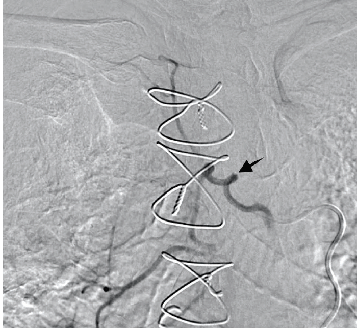 Bronchial Artery Embolization