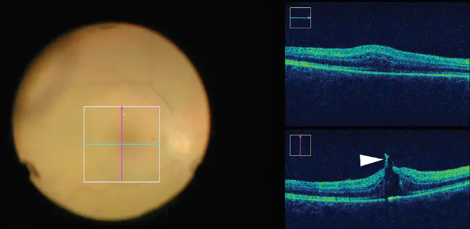 The Ins and Outs of Intraoperative OCT - Retina Today