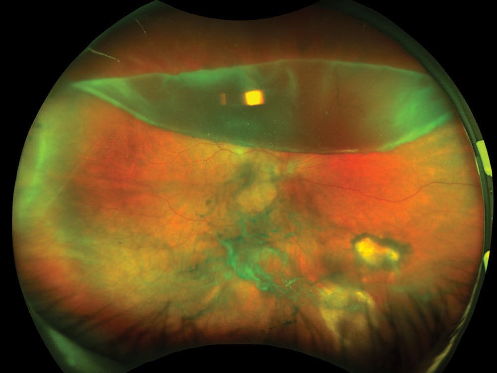 Retinal Detachments: Vitrectomy, Buckle, or Both? - Retina Today