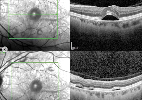 Retina - Modern Optometry