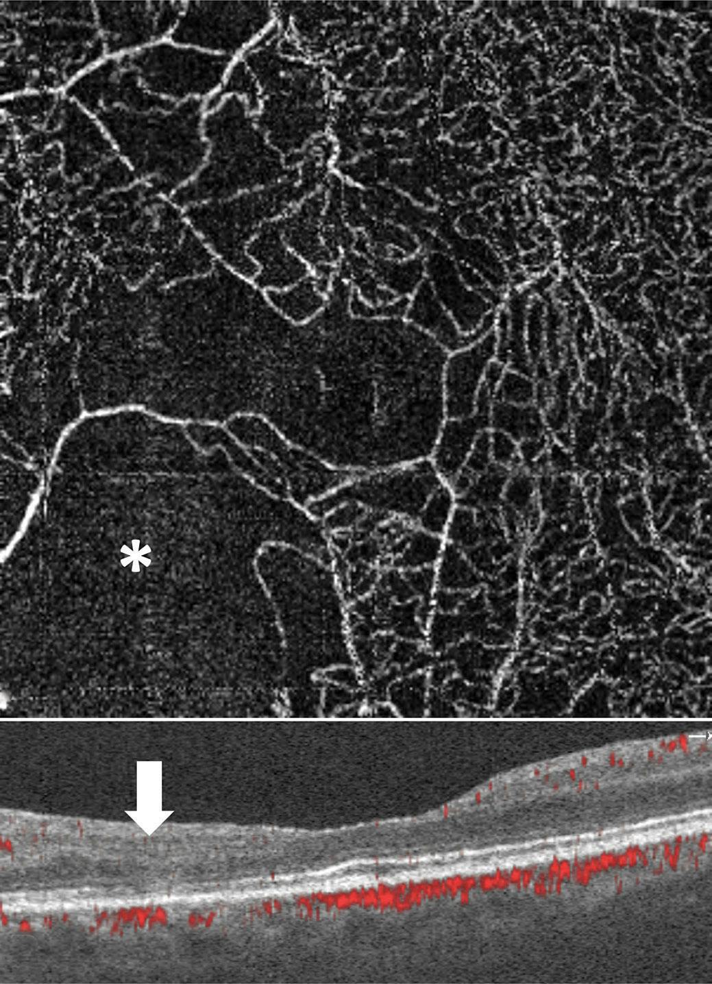 A Reference Guide for OCT Angiography - Retina Today