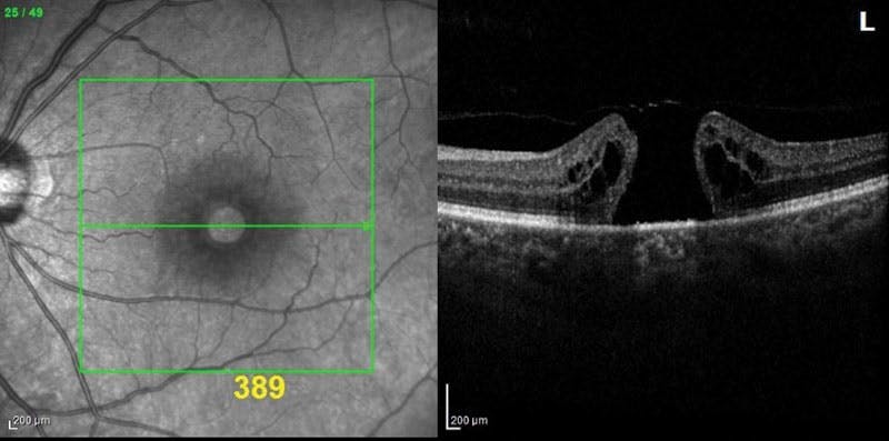 Managing Large Macular Holes: ILM Flap vs Peel - Retina Today