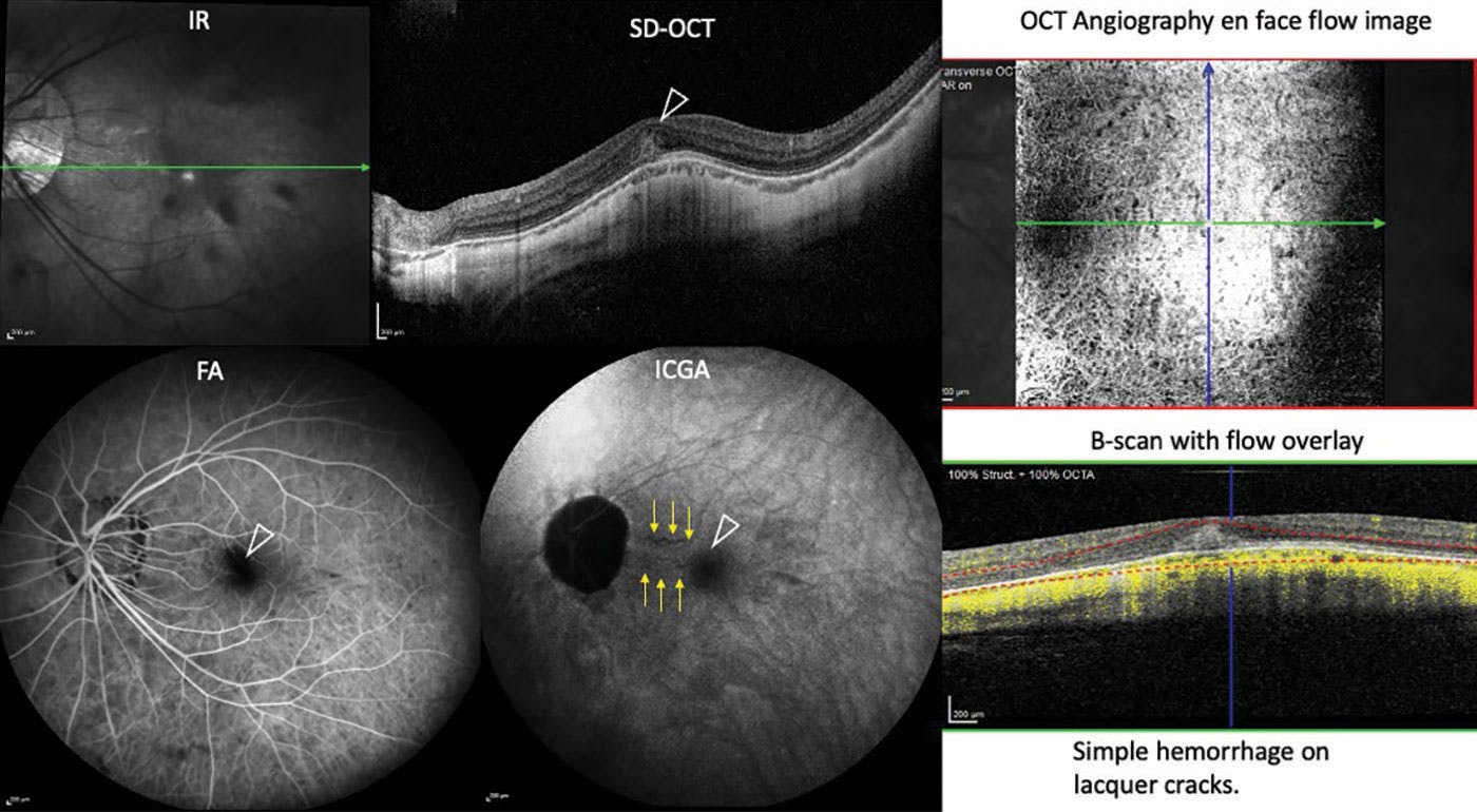 Imaging Considerations in Pathologic Myopia - Retina Today