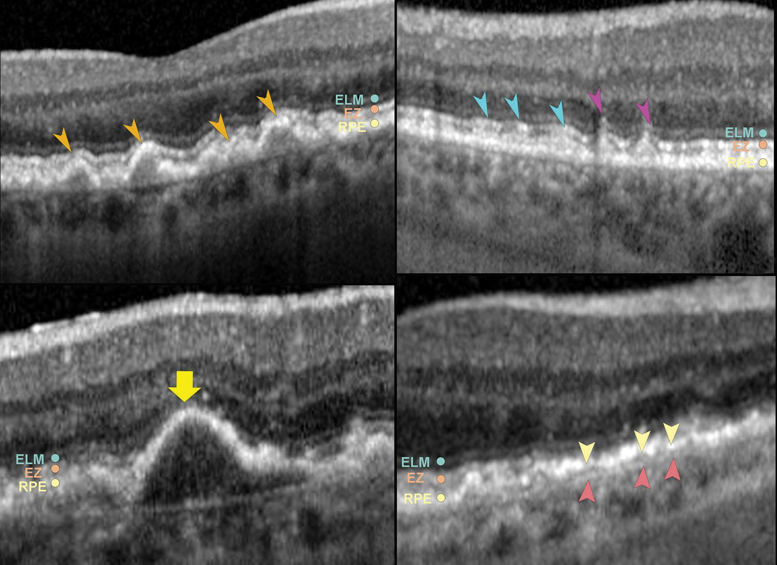 OCT Spotlight: Characterizing GA Development and Progression - Retina Today