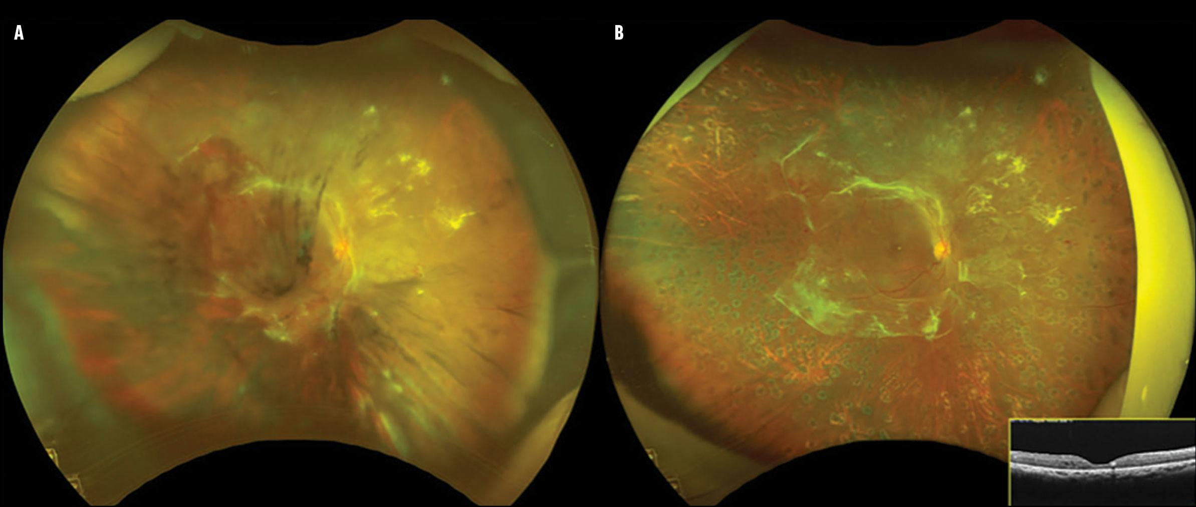 Limited Membranectomy for Diabetic TRD - Retina Today
