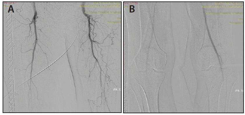 Case Report: Low-Profile Crossing and Stenting of a Long SFA Occlusion ...